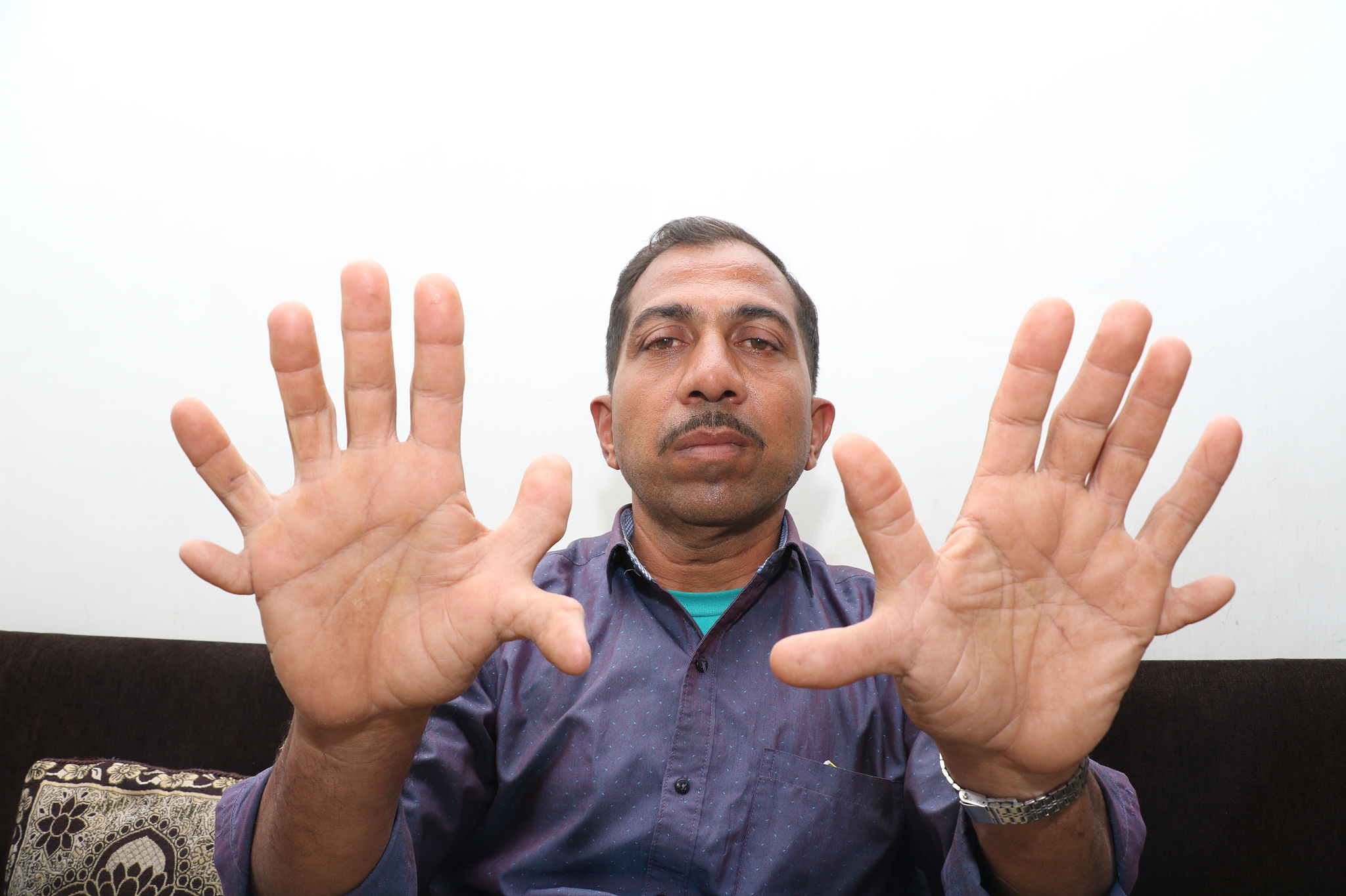Indian man shows off world's most fingers & toes - China Plus
